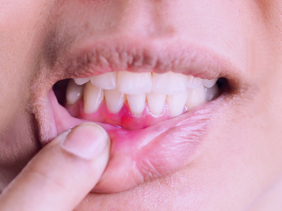 How to Treat Swollen Gums: Causes and Home Remedies | 1Dental